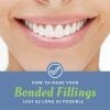 How to Make Your Bonded Fillings Last as Long as Possible | Georgian ...